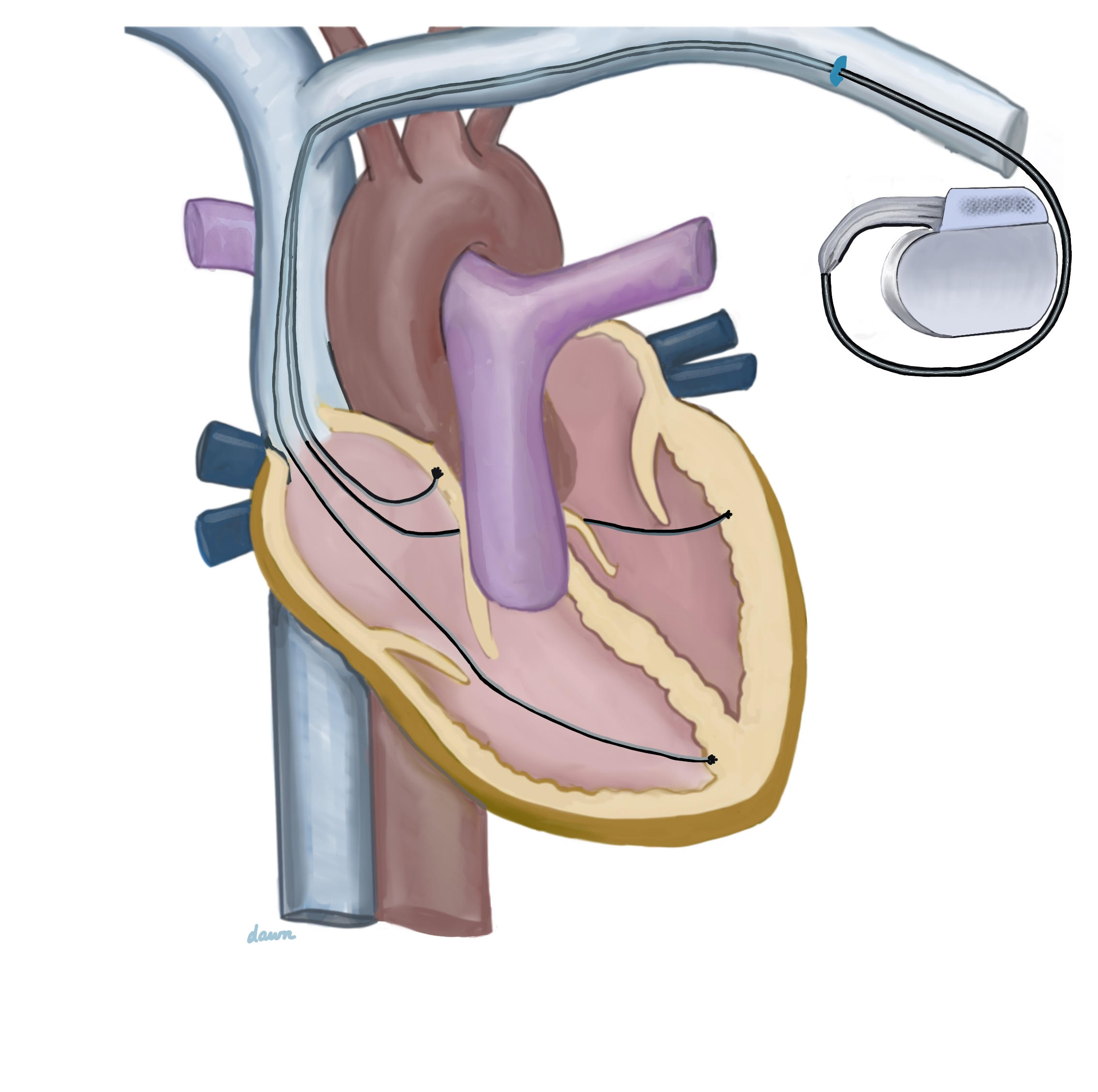 Heart Art | ECG Guru - Instructor Resources